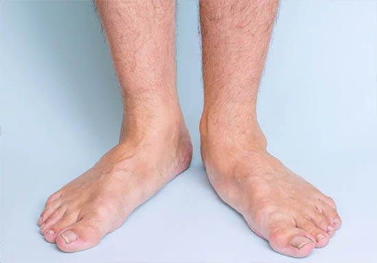 Mini-Invasive Flexor and Extensor Tenotomy Hammertoe Mallet Toe