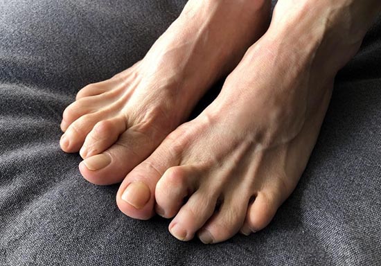 Mini-Invasive Flexor and Extensor Tenotomy Hammertoe Mallet Toe