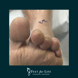 Mini-Invasive Flexor and Extensor Tenotomy Hammertoe Mallet Toe